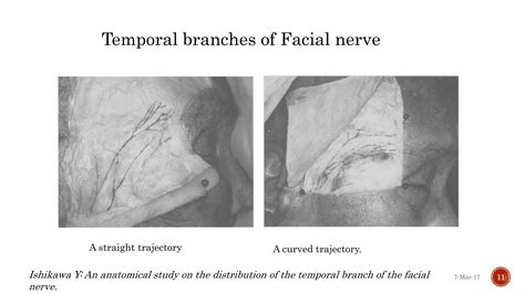Surgical Approaches To Tmj Pptx Ear Nose And Throat Conditions Diseases And Conditions
