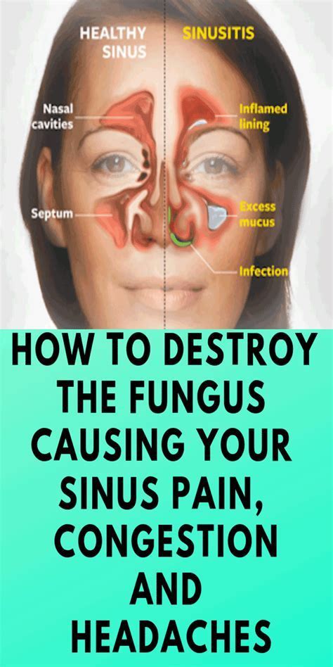 How To Drain Fluid From Maxillary Sinus