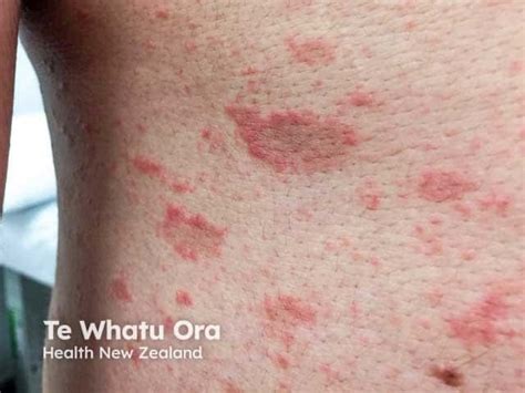 Pityriasis Rosea Pityriasis Rosea Basuk Dermatology