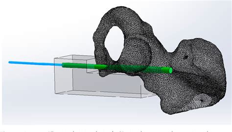 Figure 1 From A Novel Implant For Superior Pubic Ramus Fracture