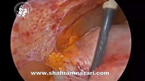 Choledochoduodenostomy After Failed Ercp In A Case Of Previous Open Cholecystectomy نماشا