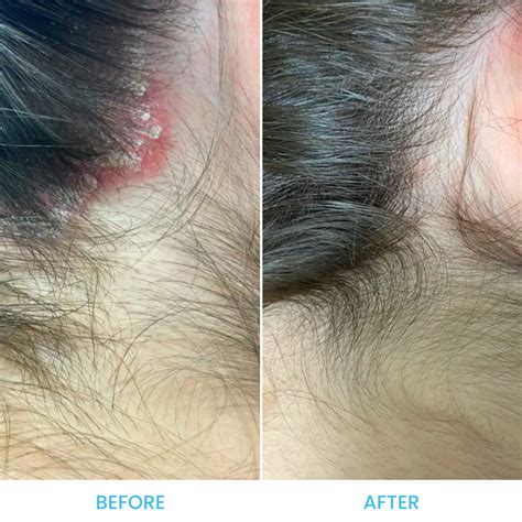 Mild Scalp Psoriasis