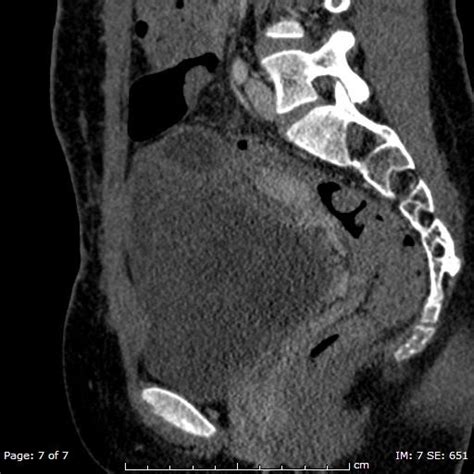 Adult Type Fibrosarcoma In A Female Patient Of 17 Years Of Age Eurorad