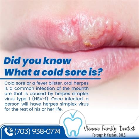 Herpes Simplex Blisters On Lips