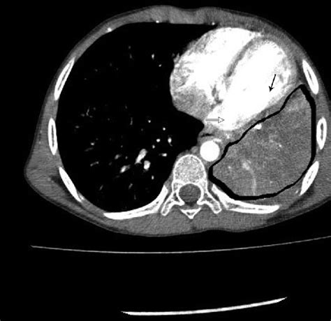 Computed Tomography Image Of The Inflammatory Myofibroblastic Tumor Download Scientific
