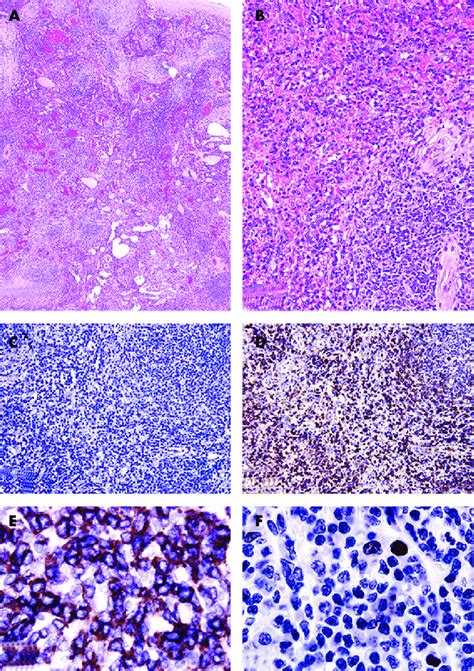 Photomicrography Of Spleen Shows Markedly Expanded Red Pulps With