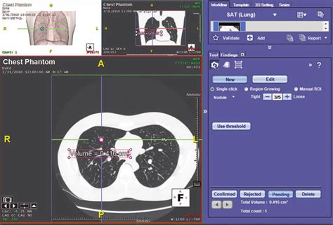 A Second Clinical Software Intuition Was Employed For Nodule