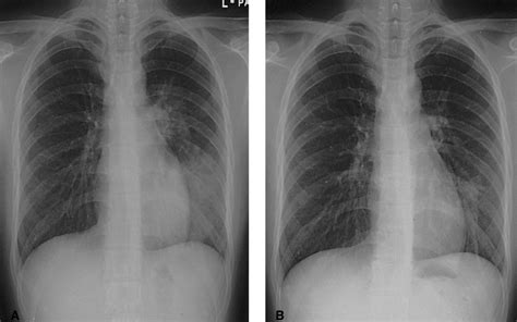A Case Of Pulmonary Cryptococcosis By Capsule Deficient Cryptococcus Neoformans