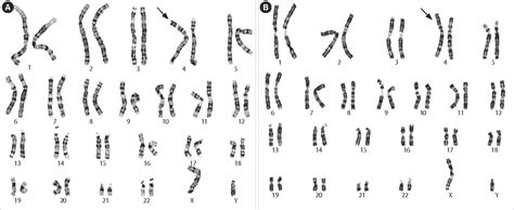 Figure 1 From Duplication Of Intrachromosomal Insertion Segments 4q32→