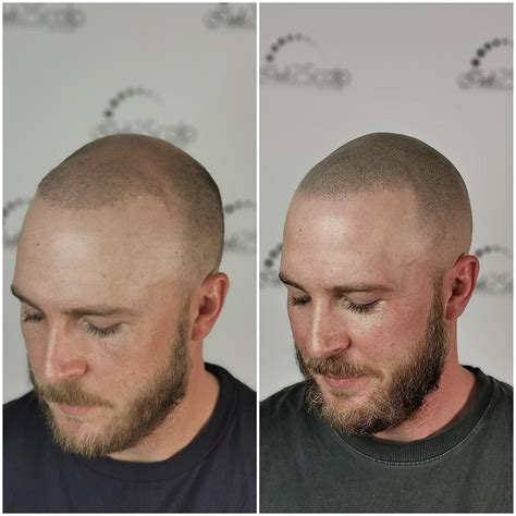 Scalp Micropigmentation For Blonde Hair Scalp Micropigmentation For Blonde Hair