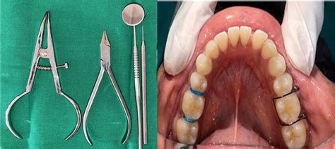 Instruments Used For Placement Of Separators Download Scientific Diagram