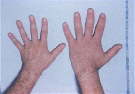 Acromegaly Excessive Growth Hormone In Adults