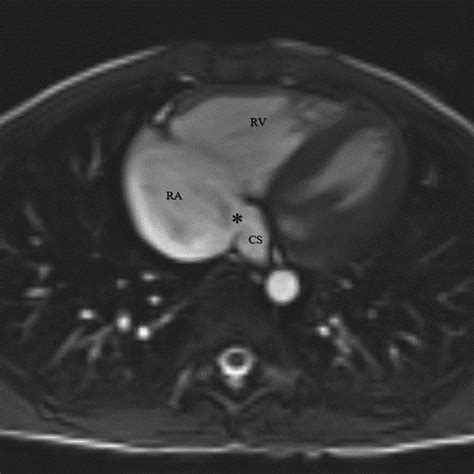Subxiphoid Short Axis View On Transthoracic Echocardiogram CSO CS Download Scientific Diagram