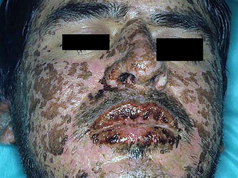 Steven Johnson Syndrome Hands