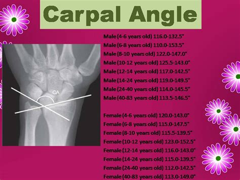 Carpal Angle Metacarpal Sign Radiology Classroom Facebook