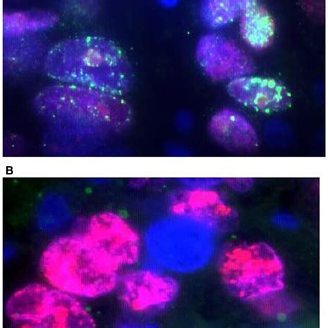 Detection Of Fancd2 Foci Formation In Human Lung Tumors By The Fatsi