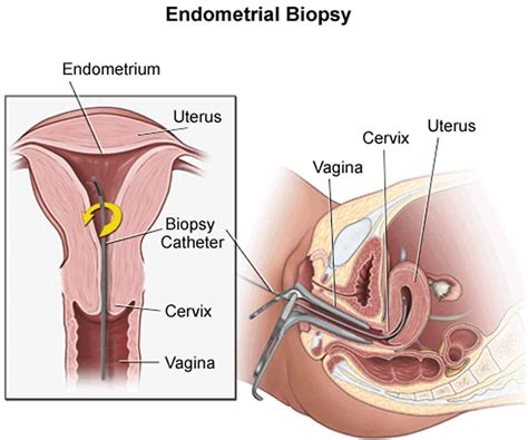 Biopsy Of Uterus Aftercare Renew Physical Therapy