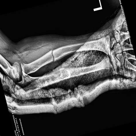 Bone Fracture Detection Object Detection Dataset V8 2024 02 06 10