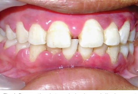 Figure 1 From Palmoplantar Keratoderma With Periodontitis Semantic Scholar