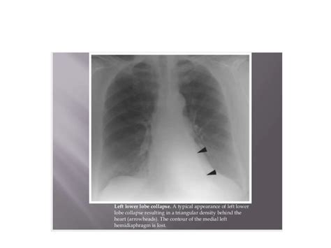 Collapse And Consolidation Pathology And Radiology Pptx
