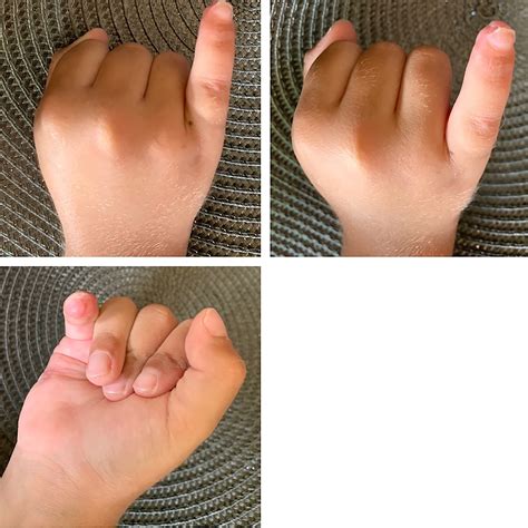 Novel Surgical Approach For Fingertip Deformity Reconstruction Of A