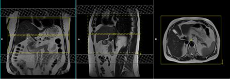 Grasp Vibe Mri Liver Grasp Vibe Siemens Free Breathing Liver Mri