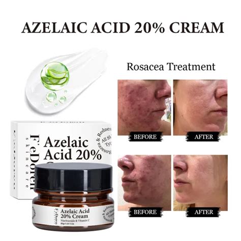 Azelaic Acid 20 Whitening Fades Acne Cream Freckle Remove Melasma Dark