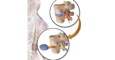 Discectomy Care At Life Physiotherapy Clinic