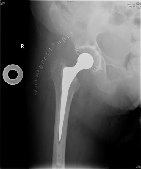 The Radiological Marker Was Placed Over The Cassette In Radiograph