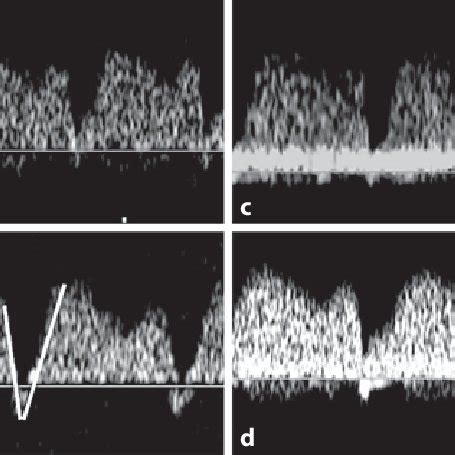 Flow Velocity Waveforms Showing A Normal Waveform A Reversed Download Scientific Diagram