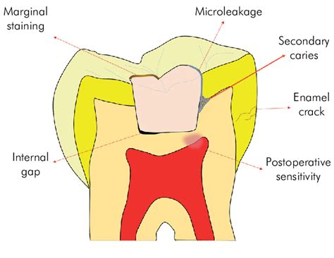 Schematic Signs And Symptomscaused By Polymerization Shrinkage