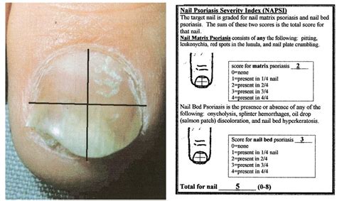 Nail Psoriasis Diagnosis Assessment Treatment Options And Unmet Clinical Needs The Journal