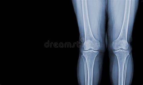 X Ray Of Human Both Knee Standing Views Normal Joints And Ligaments
