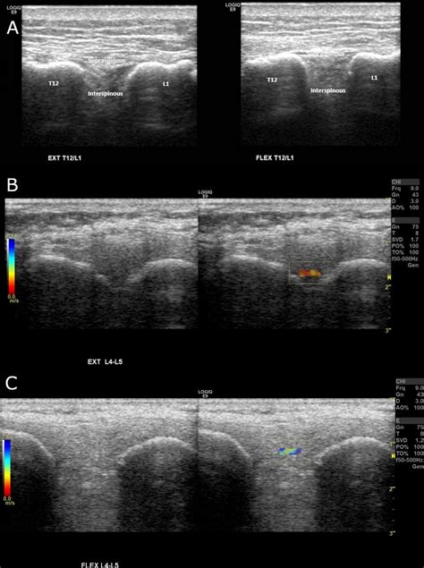 Interspinous Ligament Injection