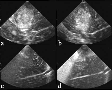 Intraoperative Pre Excision Images A And B Intraoperative Download Scientific Diagram