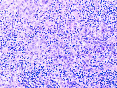 Moderately Atypical Nuclei Are Present Within Superficial Dermal Nests Download Scientific