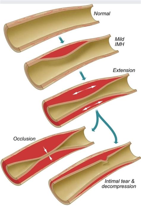 Mayo Clinic Scad Nieuws Vrouwenhart
