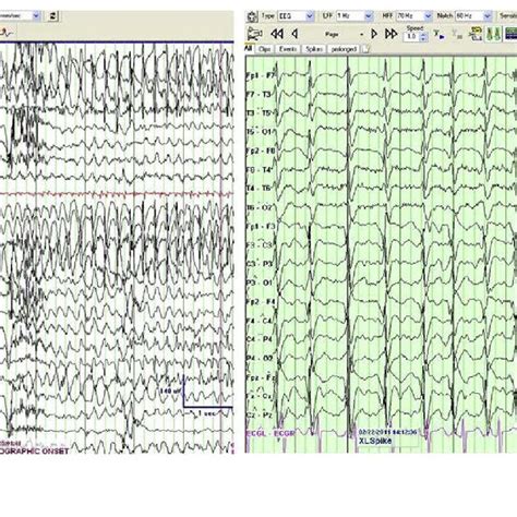 A Focal Seizure Recorded During Video Electroencephalography