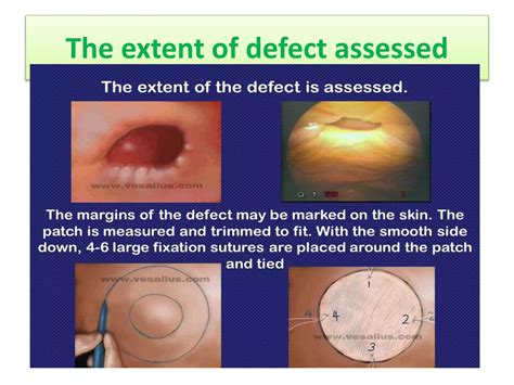 Open And Laproscopic Repair Of Incisional Hernia Pptx Digestive Disorders Diseases And