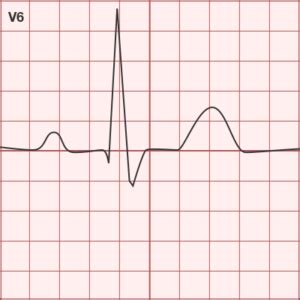 Right Bundle Branch Block Part Differential Diagnosis Of