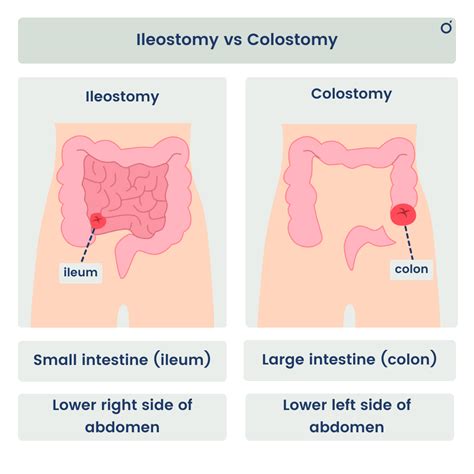 Ileostomy Vs Colostomy What Is The Difference