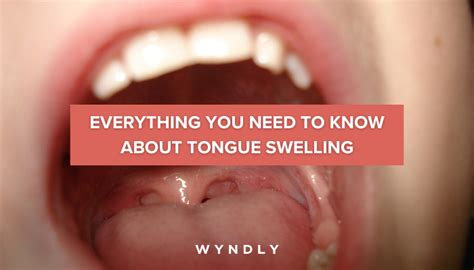 Curing Acid Bumps On Tongue