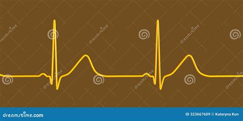 Long Qt Syndrome Ecg 1st Type 3d Illustration Royalty Free Cartoon