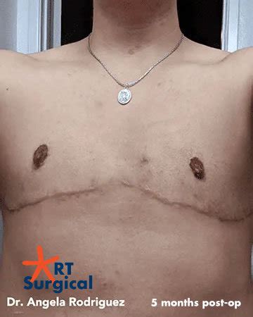 Top Surgery Results Dr Angela Rodriguez