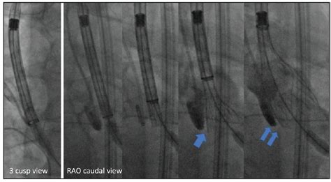 Cusp Overlap Deployment Technique—the Manchester Experience Cardiac Interventions Today