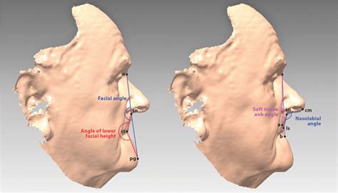 Facial Angles On 3d Facial Surface Model Left Facial Angle Dark
