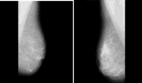Figure 1 From Classification Of Benign And Malignant Breast Tumors In Digital Mammograms Using