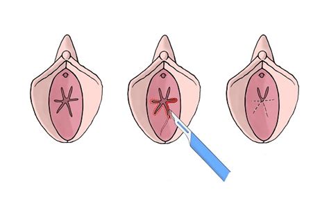ترمیم پرده بکارت دوخت بکارت دکتر عرفانه سلیمی