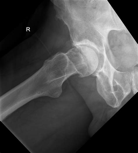 Cam Type Femoroacetabular Impingement Morphology At James Goldsbrough Blog