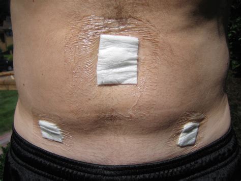 Appendix Scar Removal Before And After At James Engel Blog